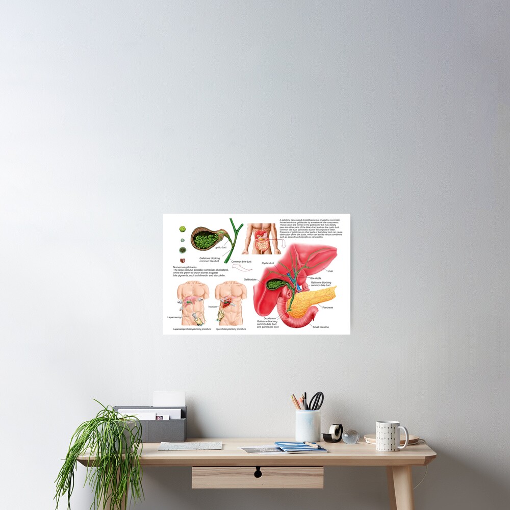 "Illustration depicting cholecystectomy, the surgical removal of the ...