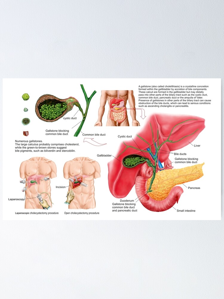 "Illustration depicting cholecystectomy, the surgical removal of the ...
