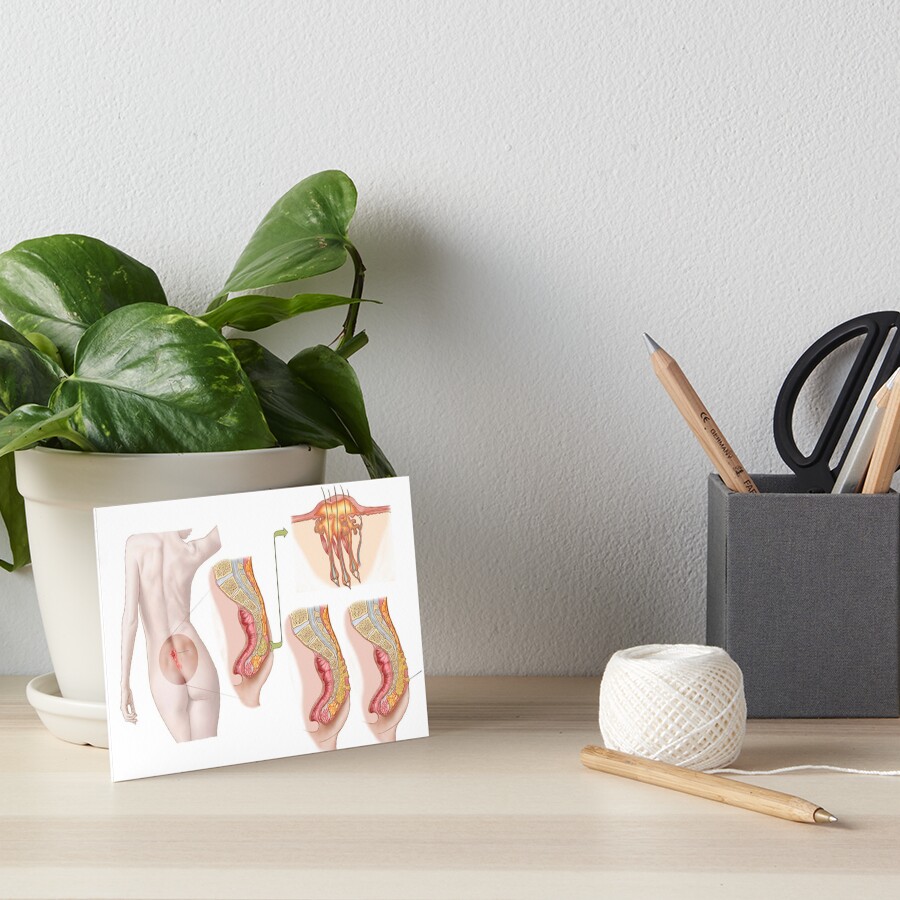 "Medical illustration of a pilonidal cyst near the natal cleft of the ...