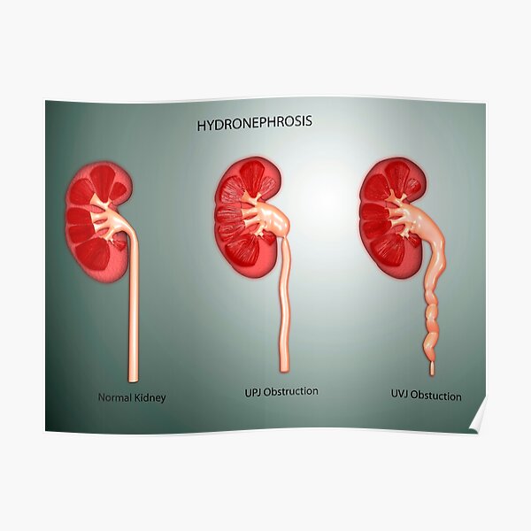 "Hydronephrosis condition of the kidney." Poster by StocktrekImages ...