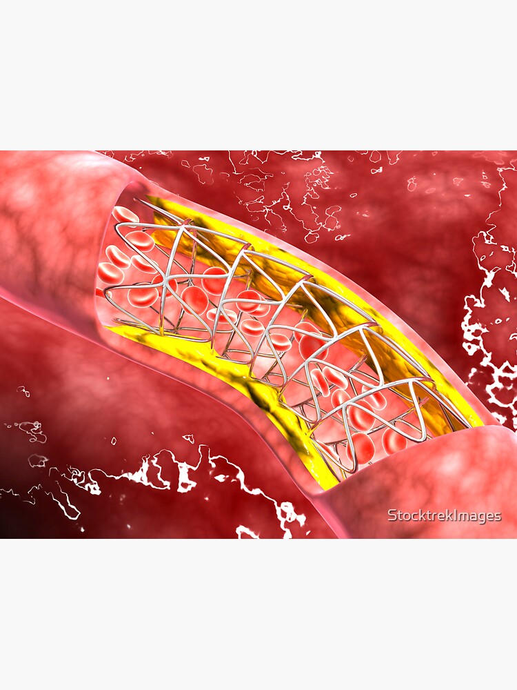 "Artery cross-section with blood flow, fat plaque and stent deployment ...