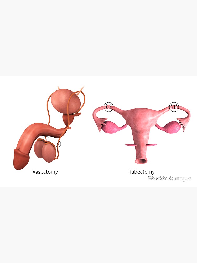 Biomedical Illustration Of A Vasectomy And Tubectomy Sticker For