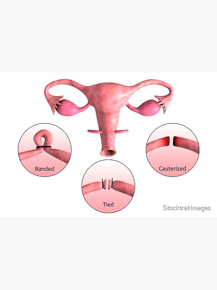 "Biomedical illustration of a tubectomy." Poster for Sale by ...