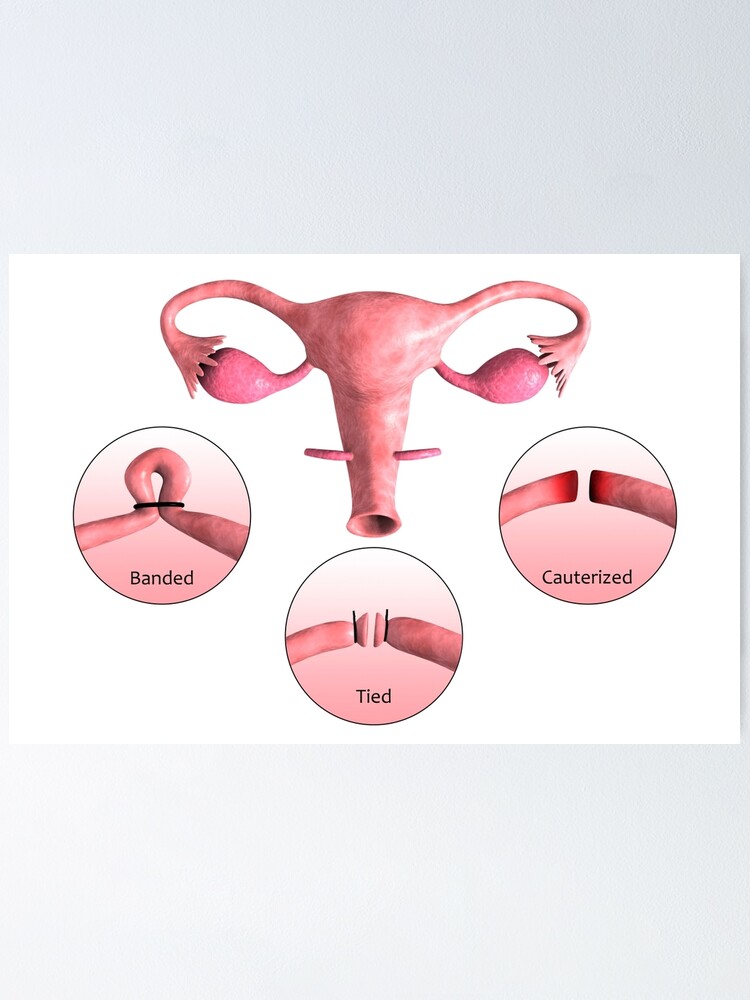 "Biomedical illustration of a tubectomy." Poster for Sale by ...