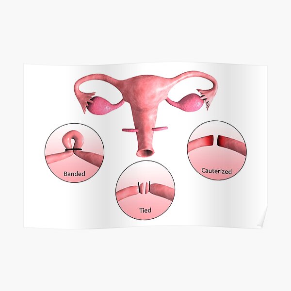 "Biomedical illustration of a tubectomy." Poster for Sale by ...