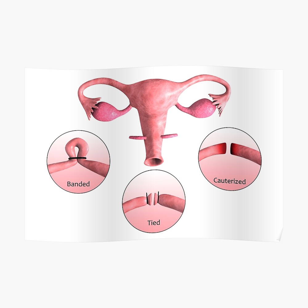 "Biomedical illustration of a tubectomy." Poster by StocktrekImages ...