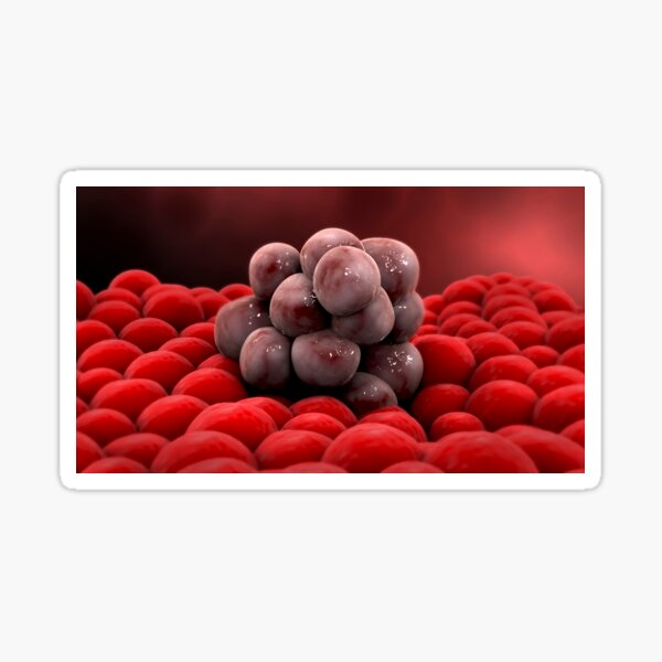 "Microscopic view of a tumor." Sticker for Sale by StocktrekImages ...