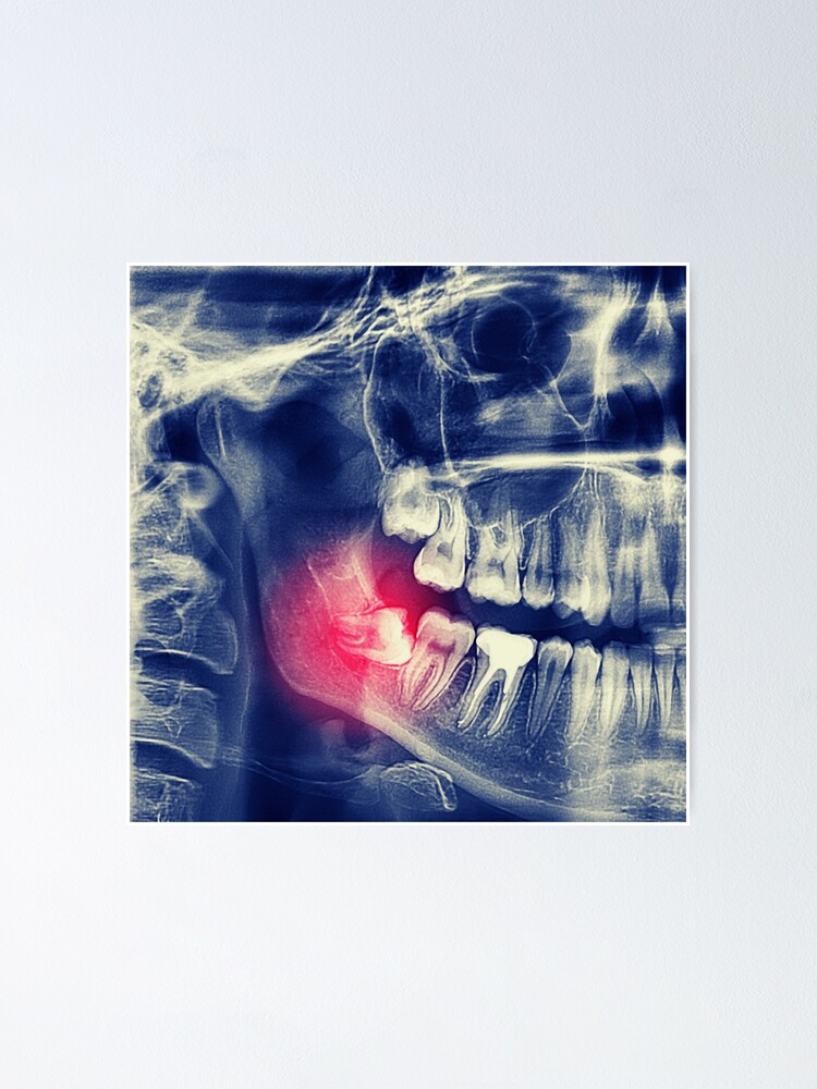 "DENTAL X-RAY" Poster for Sale by mistivelvet | Redbubble