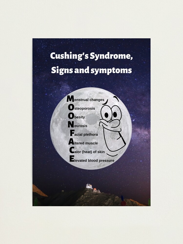 "Cushing's Syndrome, Signs and Symptoms: MOON FACE Mnemonic ...