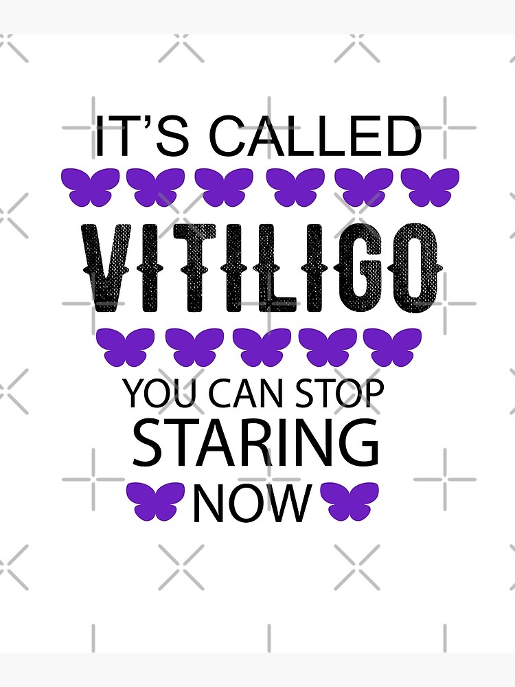 "It's called Vitiligo you can stop staring now - Vitiligo Raise ...