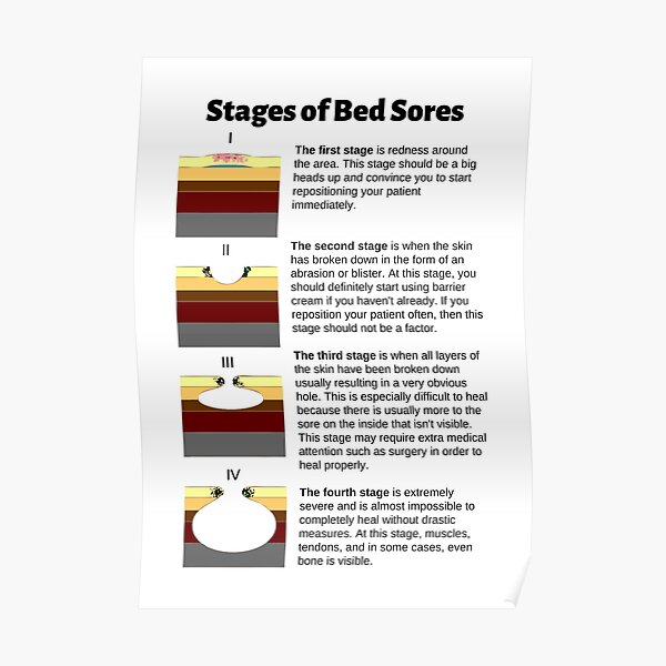 "Stages of Bed Sores Chart" Poster for Sale by Caregiverology | Redbubble