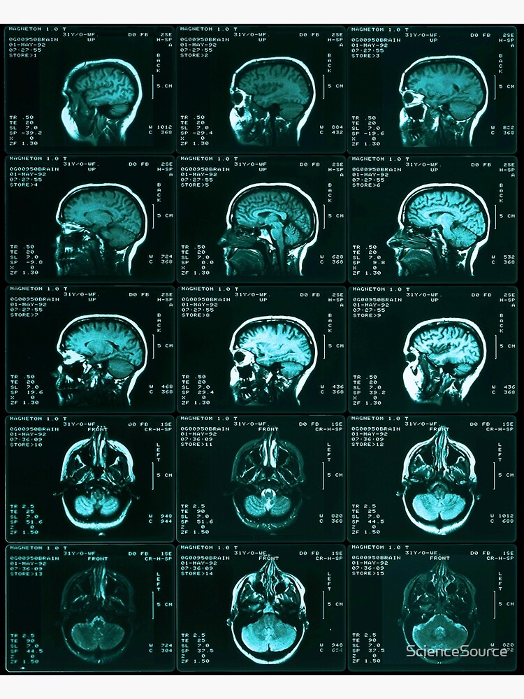 "Mri Of Normal Brain, Medical Imaging" Poster for Sale by ScienceSource ...