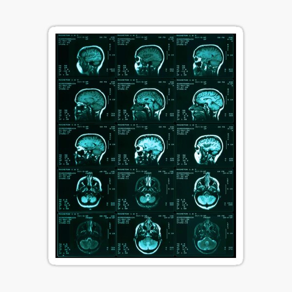 "Mri Of Normal Brain, Medical Imaging" Sticker for Sale by ...
