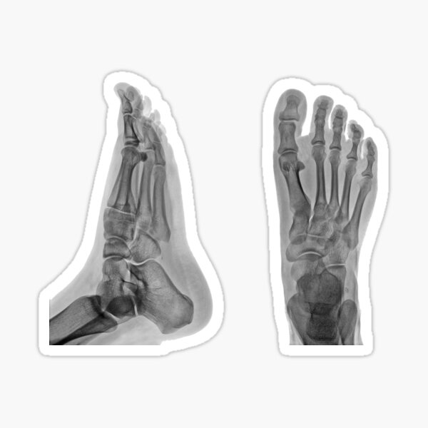 "X-rays" Sticker for Sale by AviToys | Redbubble