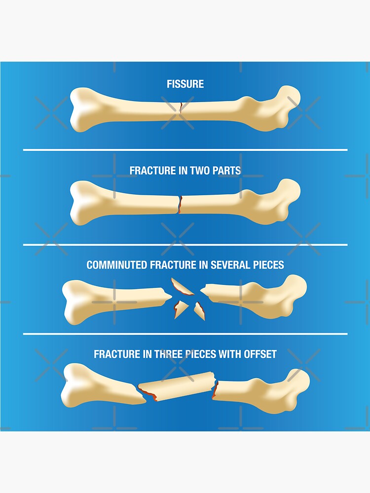 "Anatomy various skeletal bone fractures. Ideal for medical and ...