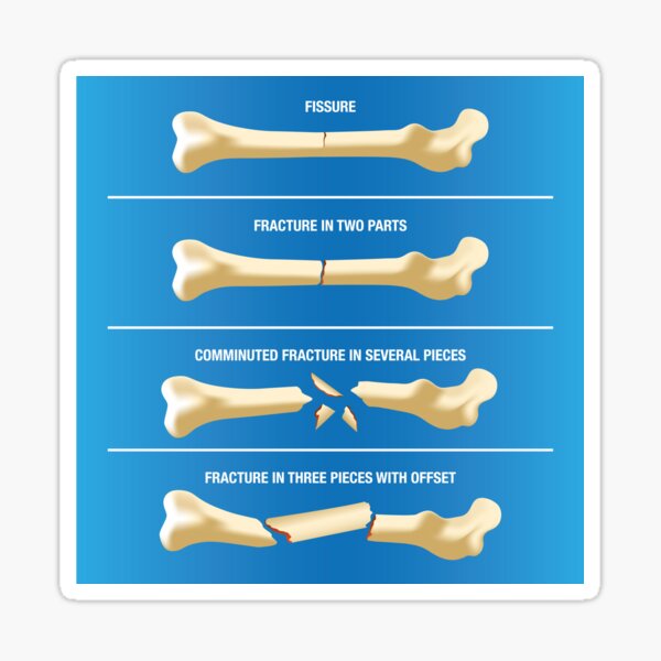 "Anatomy various skeletal bone fractures. Ideal for medical and ...