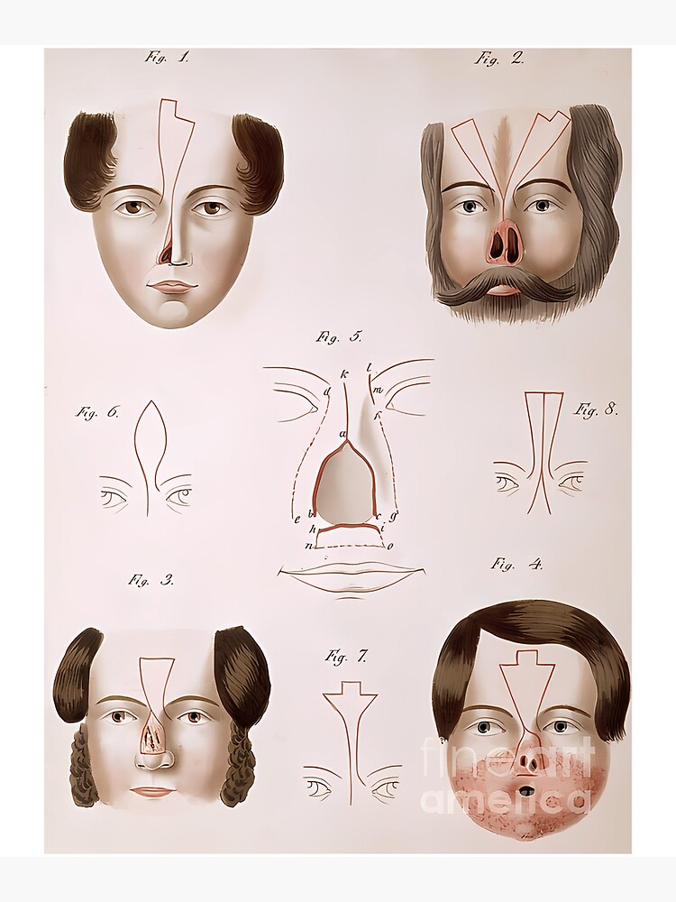"nose reconstruction 1815 medical text science source" Art Print for ...