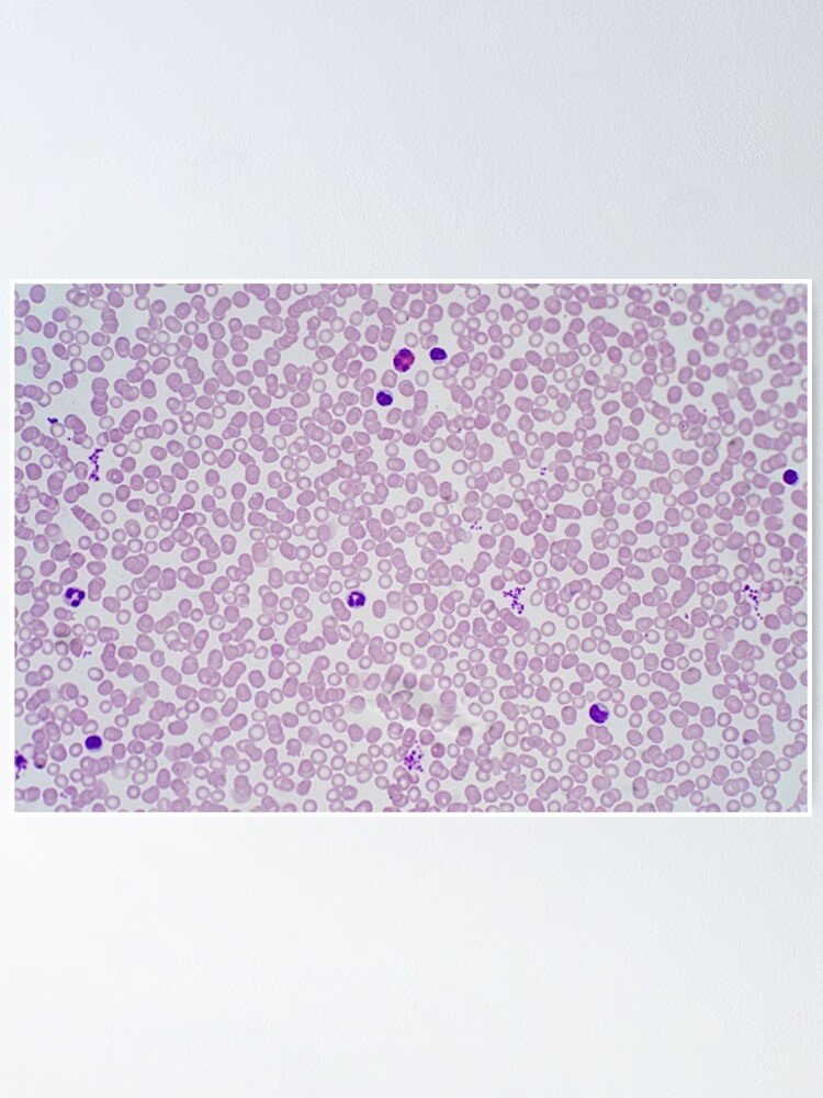 "CBC/ Whole Blood Count" Poster for Sale by bookworm7201 | Redbubble