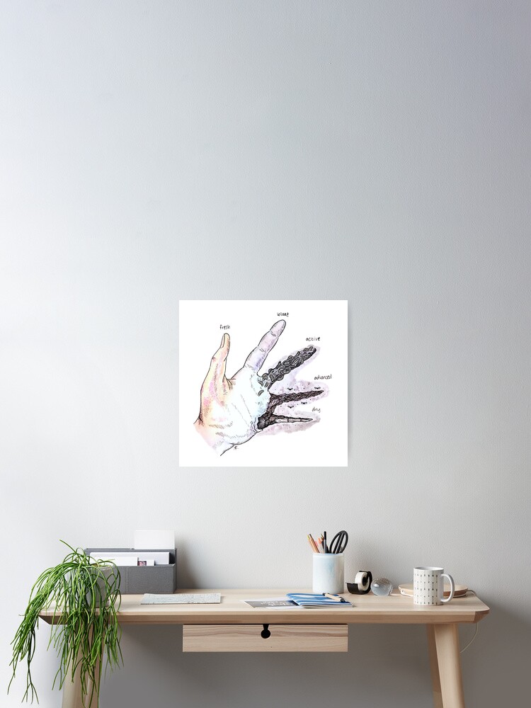 "Stages of Decay Hand by Skye Rain Art" Poster for Sale by Skye Rain ...