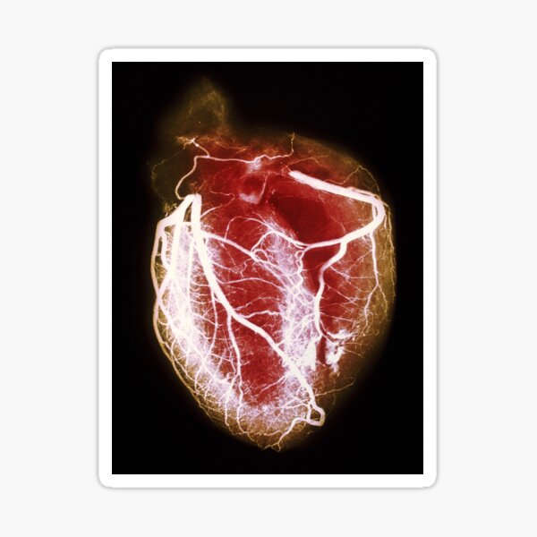 "Coloured arteriogram of arteries of healthy heart (P216/0300)" Sticker ...