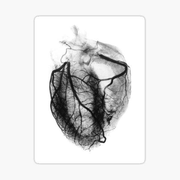 "Coronary arteriogram of arteries of the heart 1904 (P216/0201 ...