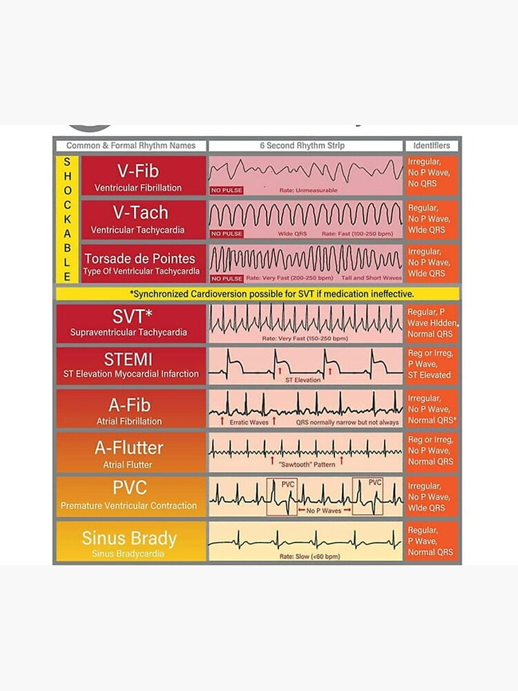 Basic Ekg