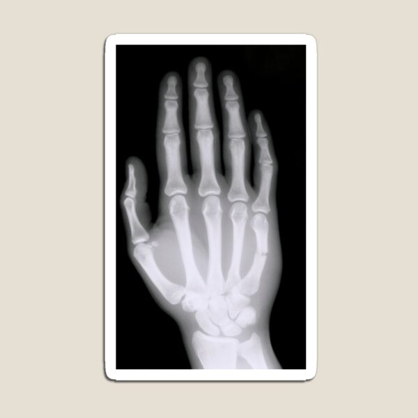Radiografía De Hueso Roto