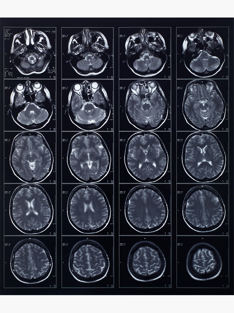 "Brain MRI x-ray" Sticker for Sale by Graphics Design | Redbubble