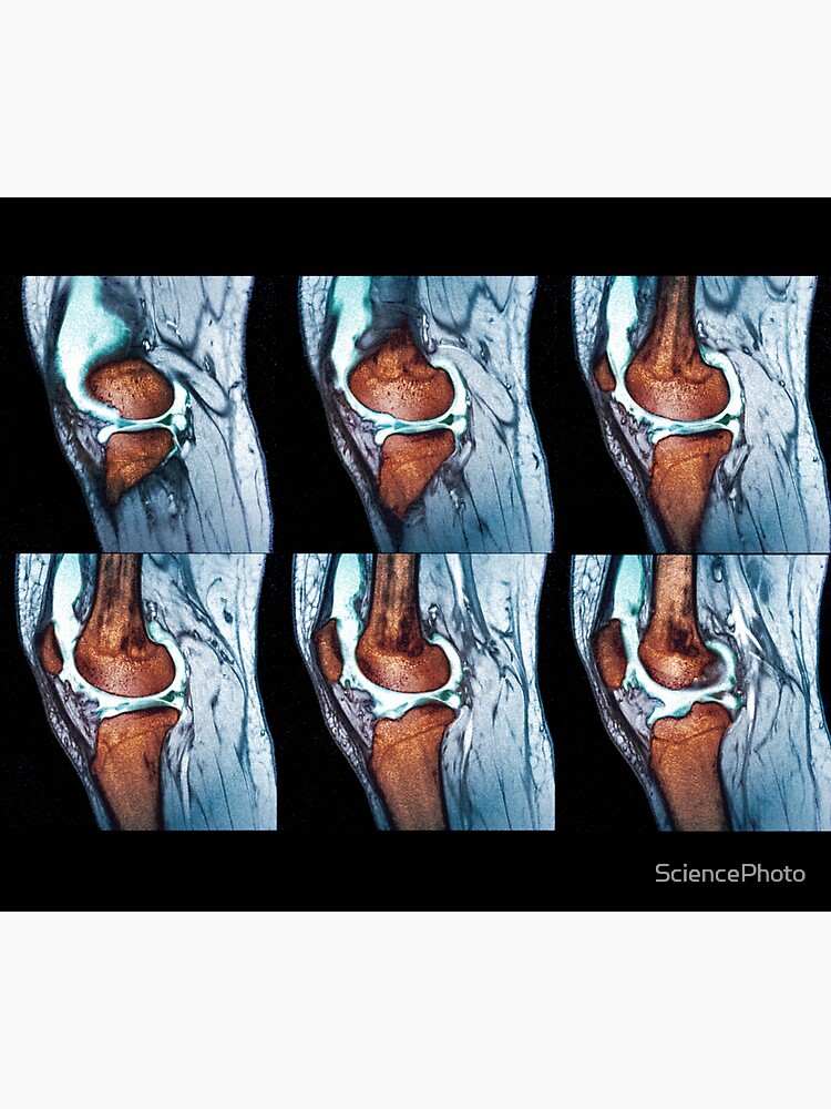 "Knee sprain, MRI scans (C021/2240)" Sticker for Sale by SciencePhoto ...