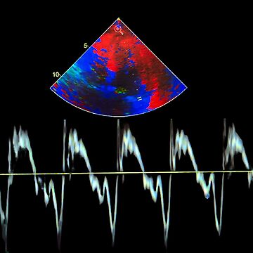 "Echocardiogram doppler map and waveform tracing" Sticker for Sale by ...
