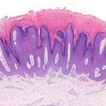 "Skin wart, light micrograph (C024/8119)" Sticker for Sale by ...