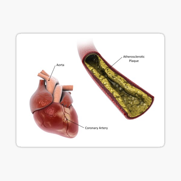 "STK701307H-A healthy artery compared to an unhealthy artery with ...