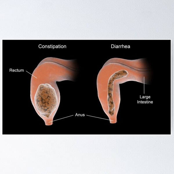 "STK701377H-Constipation vs. diarrhea" Poster for Sale by ...