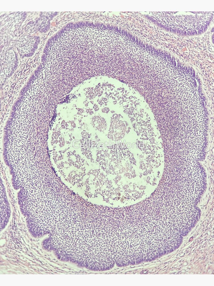 "Skin cyst under the microscope - histology" Sticker for Sale by ...