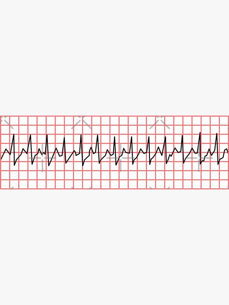"Supraventricular Tachycardia (SVT) Rhythm Strip (Accurate)" Sticker ...