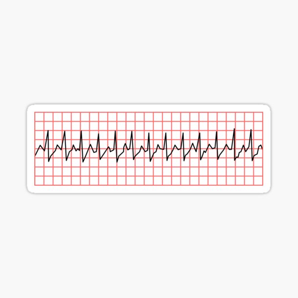 "Supraventricular Tachycardia (SVT) Rhythm Strip (Accurate)" Sticker ...