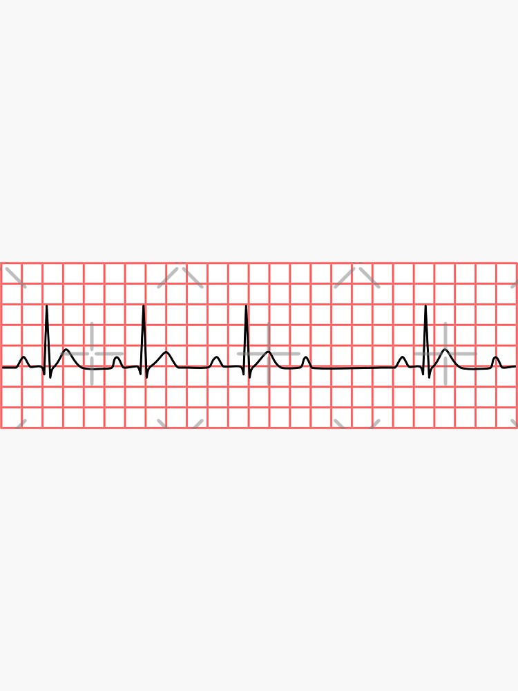 "Second Degree heart, Atrial Ventricular, Block Mobitz Type 1 ...
