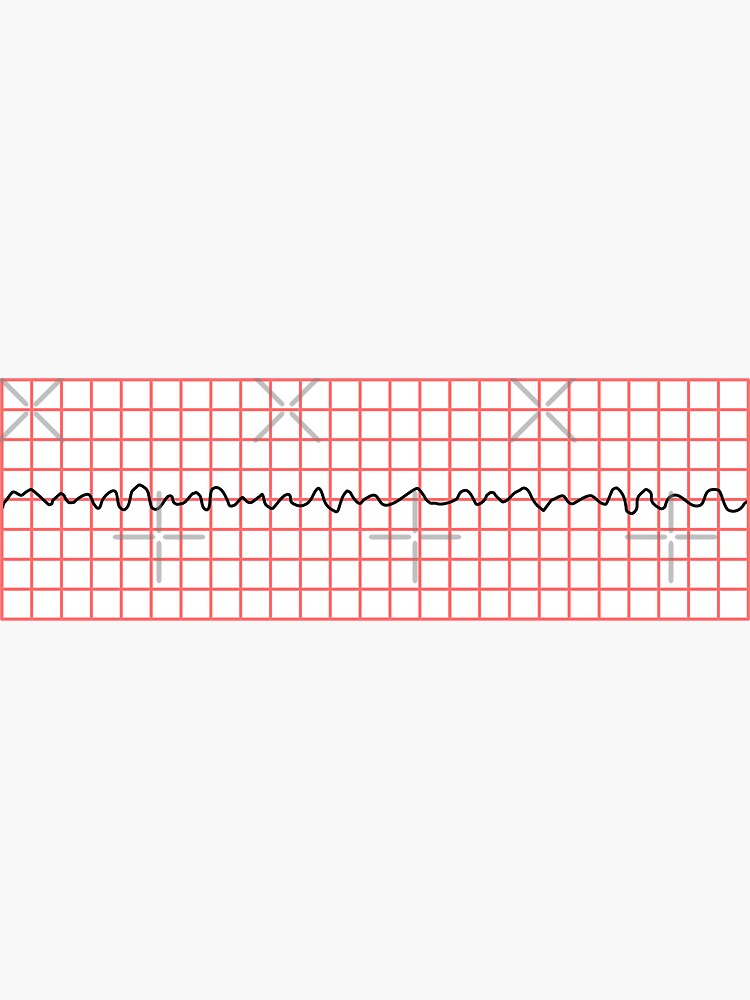 "Ventricular Fibrillation EKG Strip" Sticker for Sale by StegoStego ...