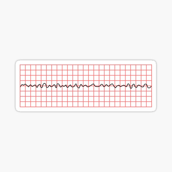 "Ventricular Fibrillation EKG Strip" Sticker for Sale by StegoStego ...