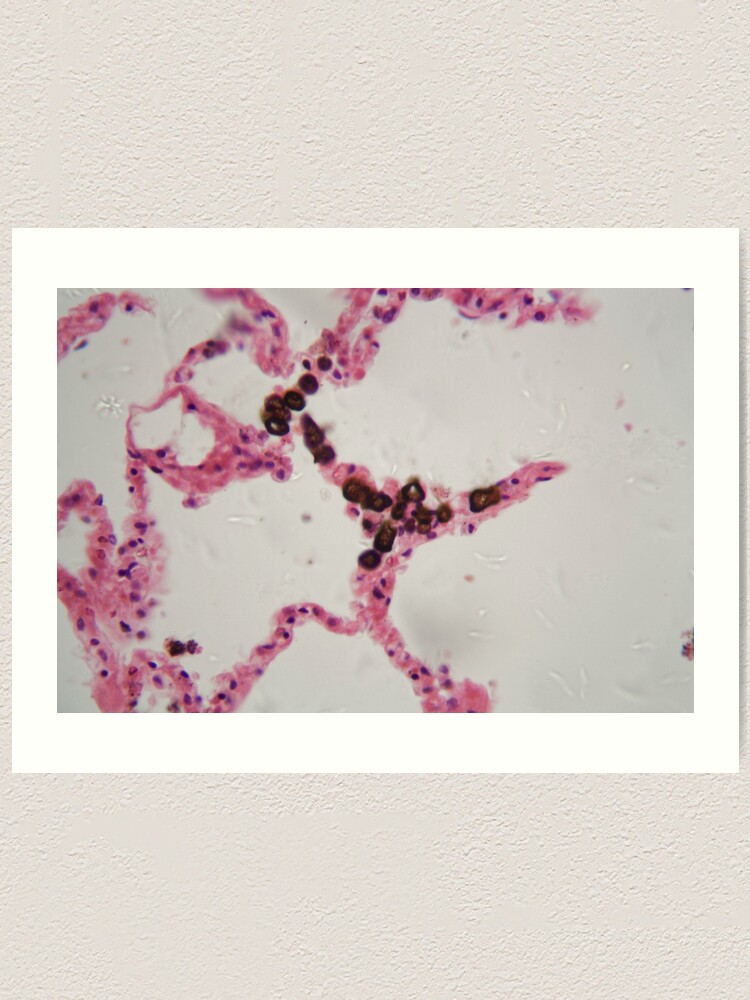 "Human lung tissue with dust and coal particles under the microscope ...