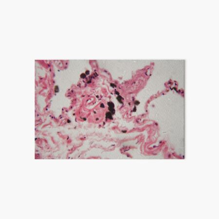 "Human lung tissue with dust and coal particles under the microscope ...