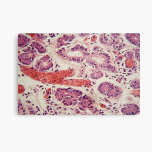 "Human lung tissue with Pulmonary embolism under a microscope." Metal ...