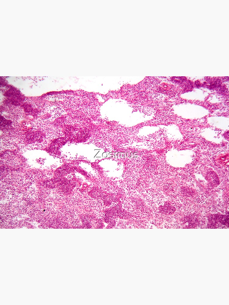 "Lymph node cells under the microscope." Sticker for Sale by Zosimus ...