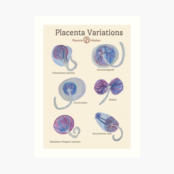 "Placenta Variations Teaching" Art Print for Sale by placentawisdom ...