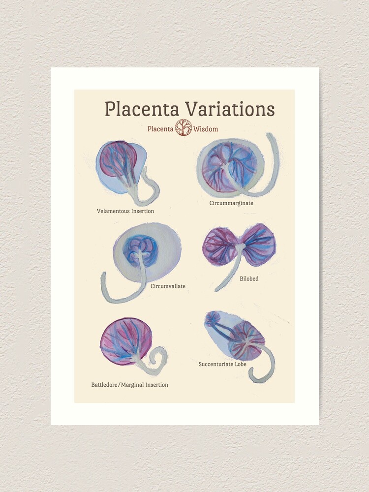 "Placenta Variations Teaching" Art Print for Sale by placentawisdom ...