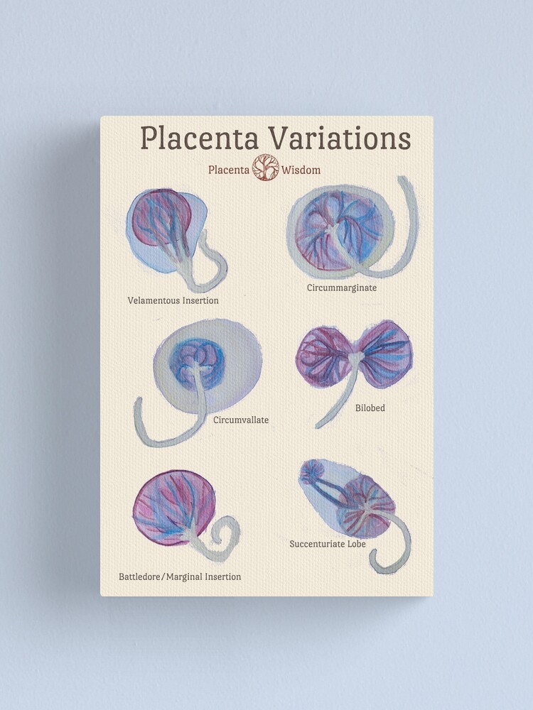 "Placenta Variations Teaching" Canvas Print for Sale by placentawisdom ...