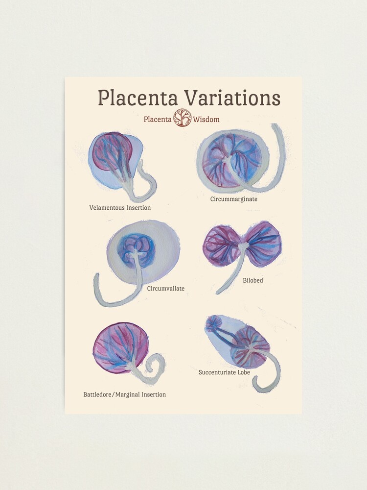 "Placenta Variations Teaching" Photographic Print for Sale by ...