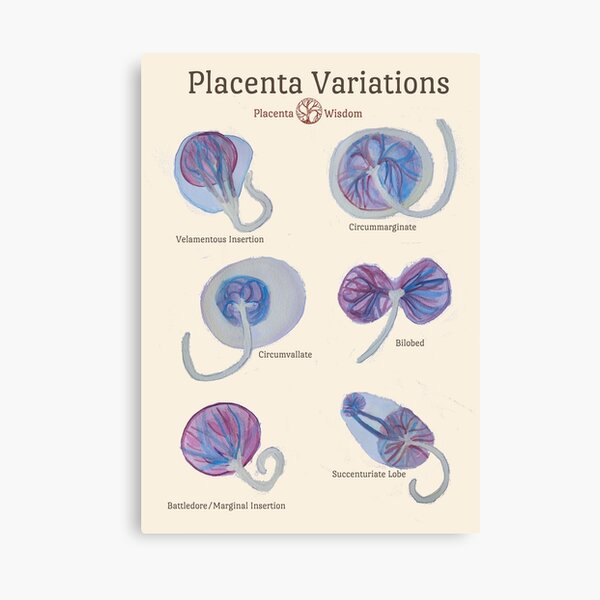 "Placenta Variations Teaching" Canvas Print for Sale by placentawisdom ...