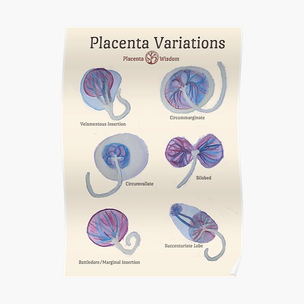 "Placenta Variations Teaching" Poster for Sale by placentawisdom ...