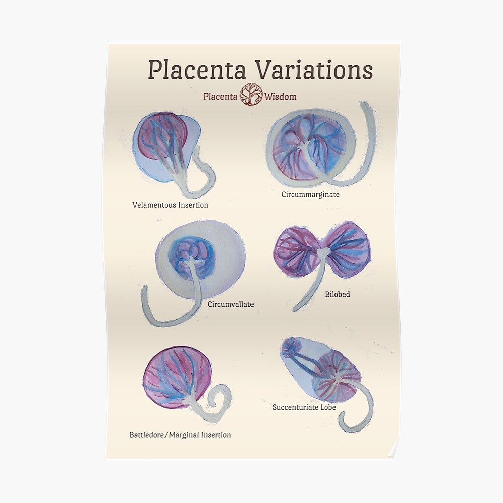 "Placenta Variations Teaching" Poster by placentawisdom | Redbubble